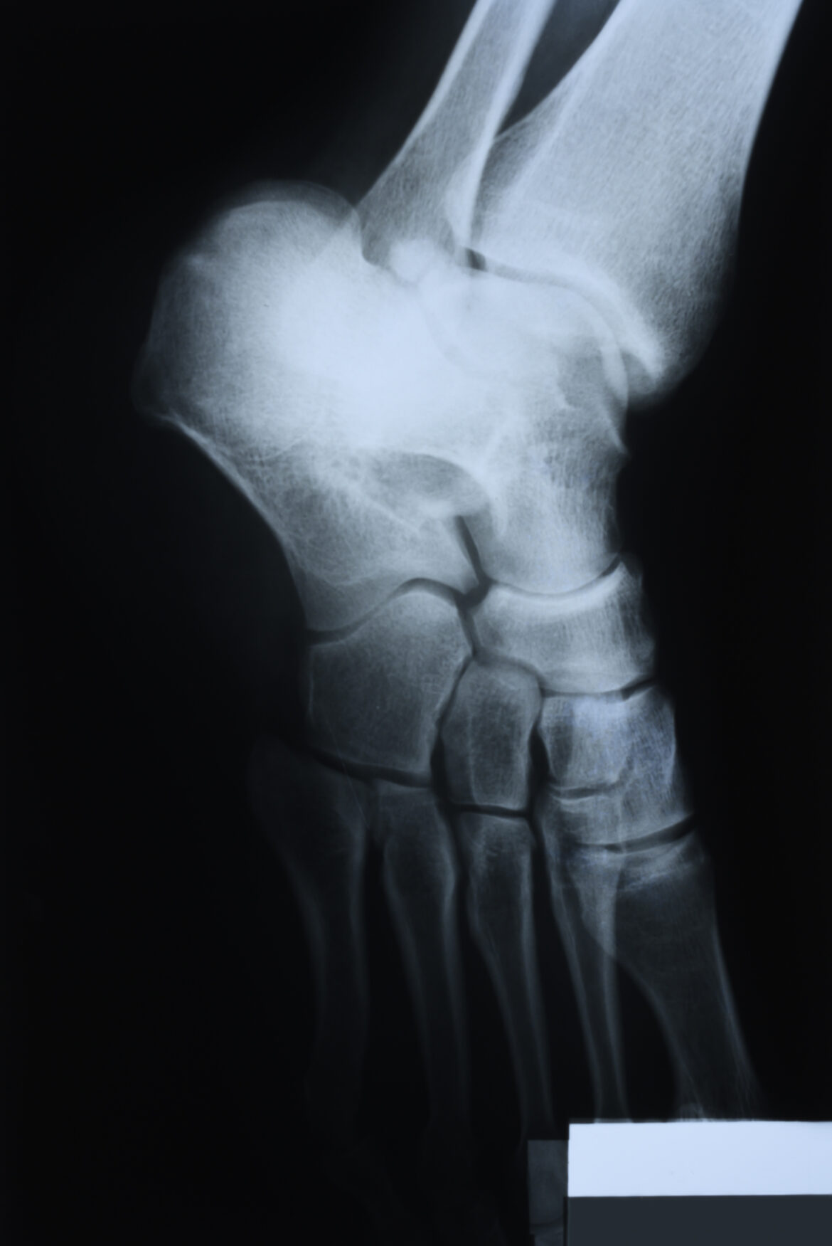 Maladie de Sever : diagnostic en 5 min - ORTHOREPASS